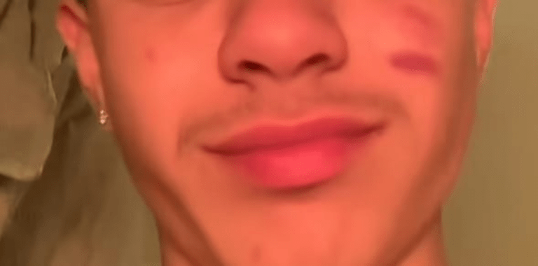 Cicatrice francese trend su Tik Tok: cos'è e perché è di tendenza, l ...